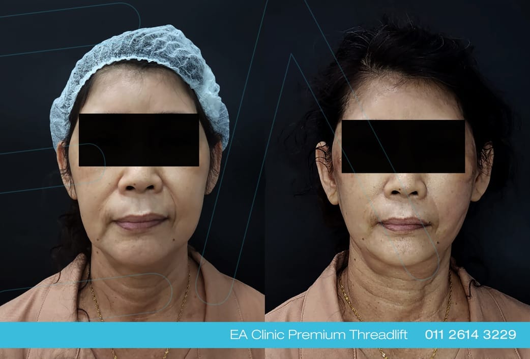 Rejuvenate Your Look with Face Thread-lifting: A Comprehensive Guide ...